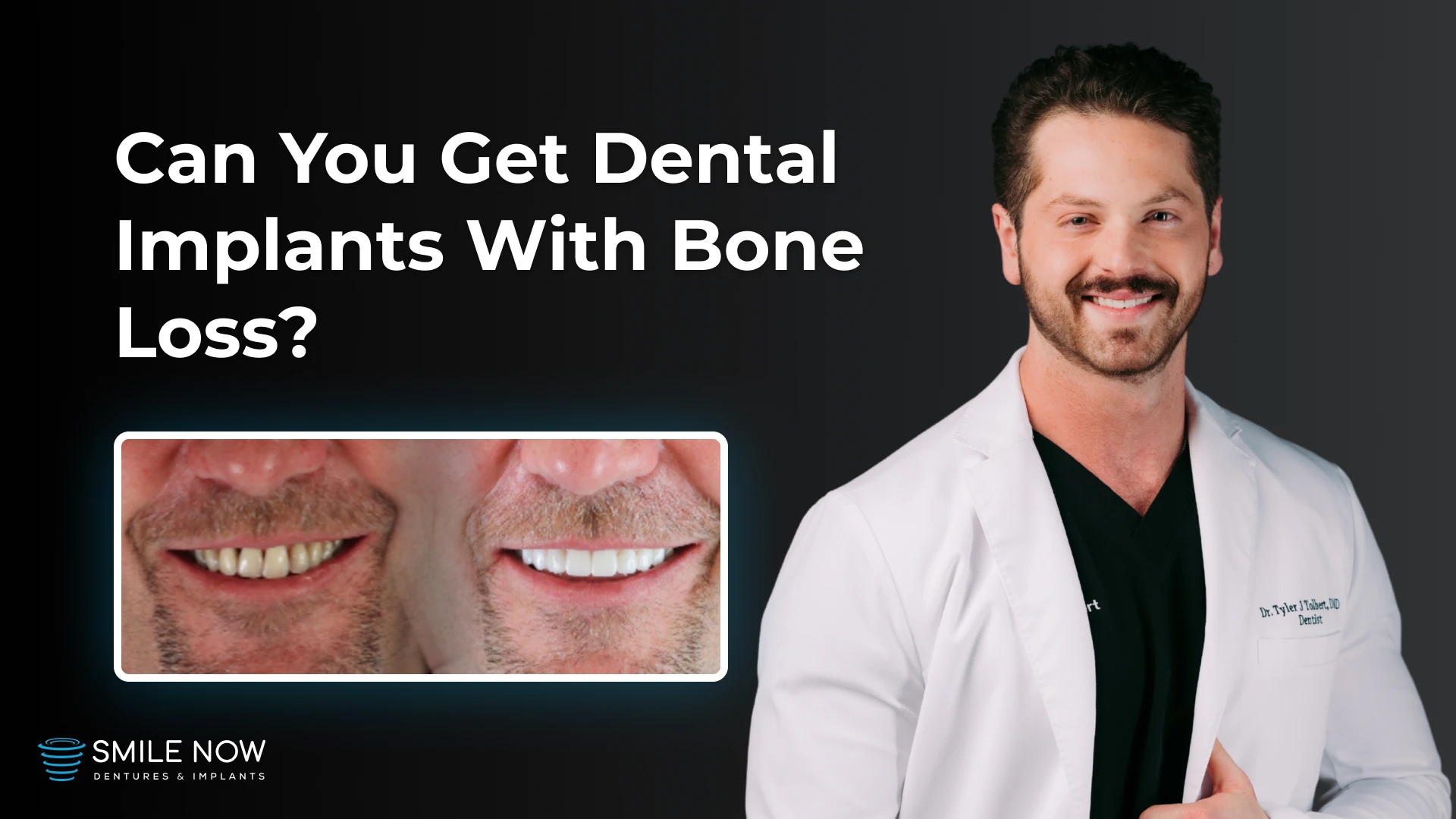 Bone Loss In Teeth: Why You Can Still Get Dental Implants | Smile Now ...