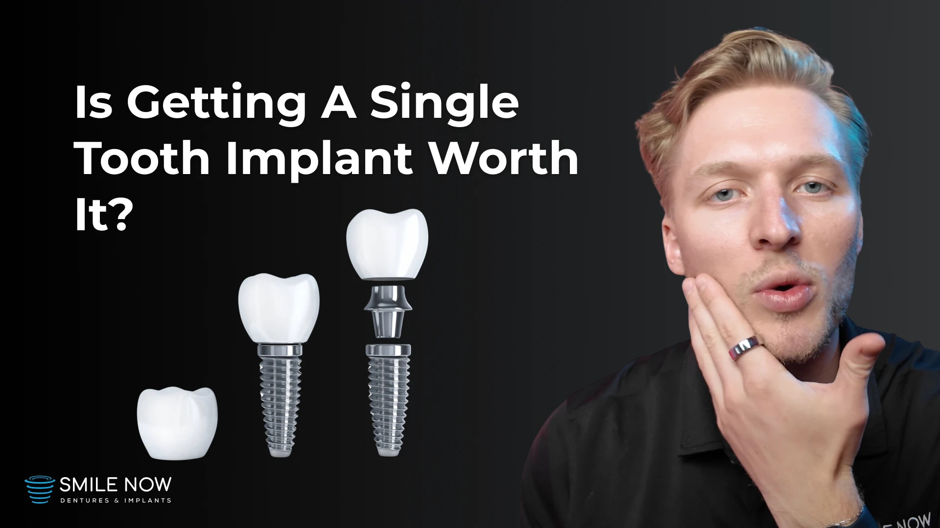 Is A Single Tooth Implant Worth It? A Look At Real Transformations ...